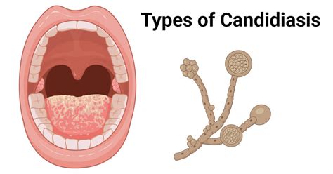 Candidiasis Of The Skin Causes Symptoms And Treatment 49 Off