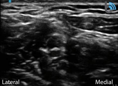 Interscalene Block Flashcards Quizlet