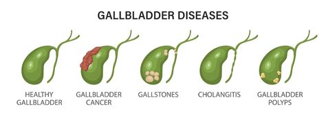 Premium Vector Gallbladder Diseases Infographics Gallstone Disease