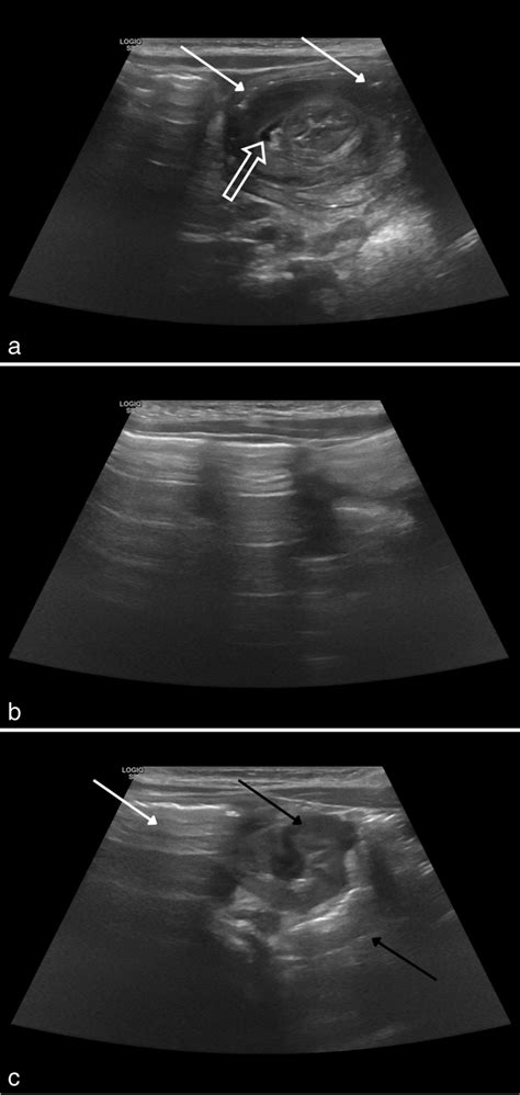 Sequence Of Sonographic Images During Pneumatic Reduction Of An