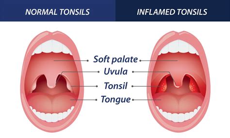Tonsillitis Nurses Revision