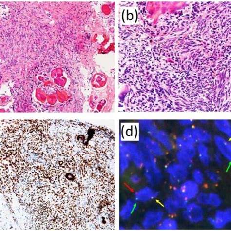 Pathological Findings A The Lesion Consisted Of Proliferation Of