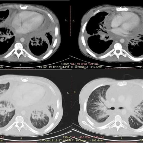 Ct Chest Showing Diffuse Mediastinal Infiltrative Soft Tissue Lesion