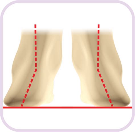 孩子足外翻，需要矫正鞋垫与矫正鞋的双重呵护 知乎