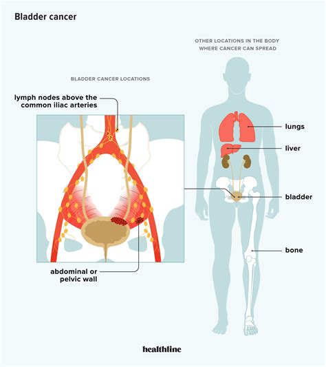 Does Bladder Cancer Spread Quickly Types Symptoms And Treatment