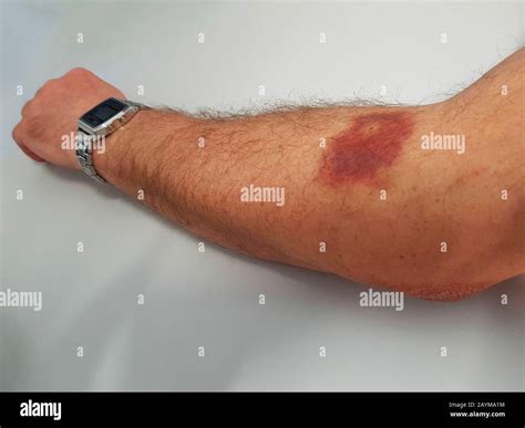 Bruise At An Arm After Placing A Catheter And Using A Blood Thinner