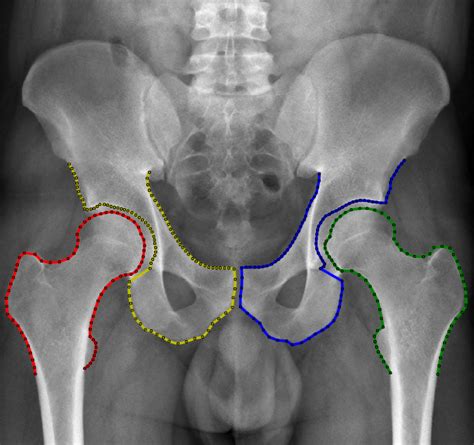 Automatic Quantification Of Hip Osteoarthritis From Low Quality X Ray Images Hans Lamecker