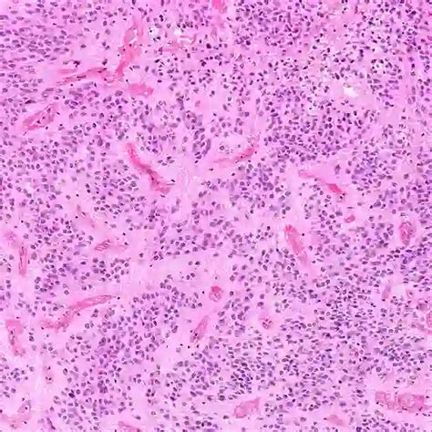 Ependymoma Test Price In Delhi Cost Near Me India Ganesh Diagnostic