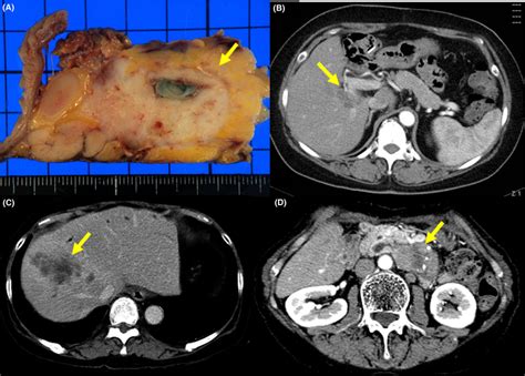 Cholangiocarcinoma And Pancreatic Cancer Detected After The Biliary