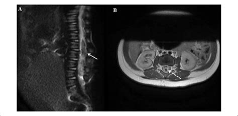 A Sagittal Diffusion Weighted Imaging Dwi Series Showed Diffusion