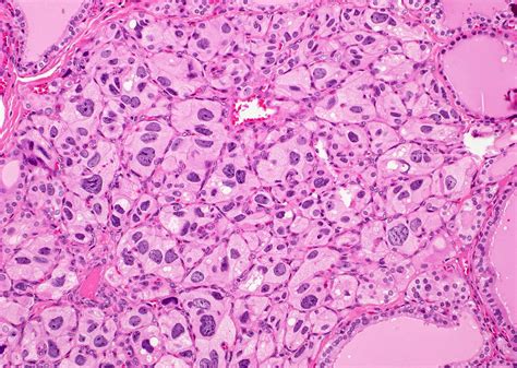 Pathology Outlines Graves Disease