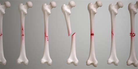 Multiple Fracturesrita Henn And Partners Rehab