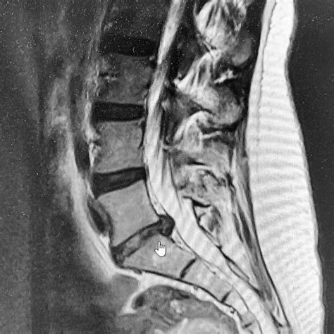 Has Anyone Had Success With An Epidural Injection Rsciatica