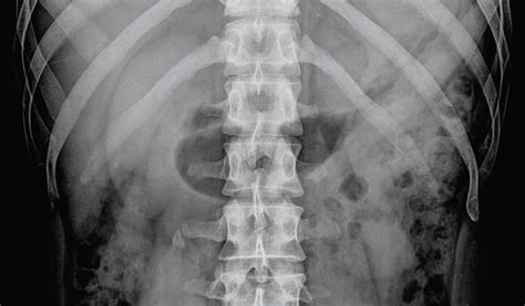 Spine X Ray Herniated Disc At Damian Goad Blog