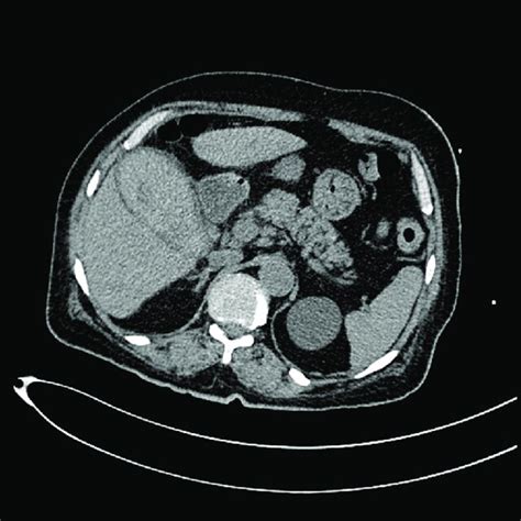 Axial Non Contrast Ct Scan Of The Abdomen Shows Distended Gallbladder