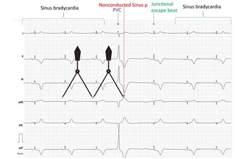 Sinus Bradycardia And More Ecg Guru Instructor Resources