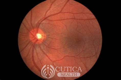Glaucoma Causes And Treatments