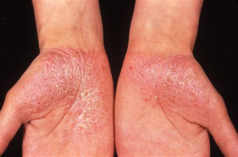 Examining The Potential Benefits Of Secukinumab In Palmoplantar
