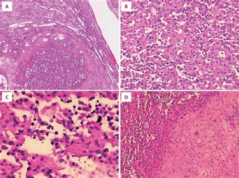 Histopathology Of Renal Anastomosing Hemangioma Hande A Low Power Download Scientific