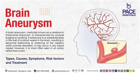 Brain Aneurysm Symptomstreatment Atlantic Brain Spine Atlantic Brain