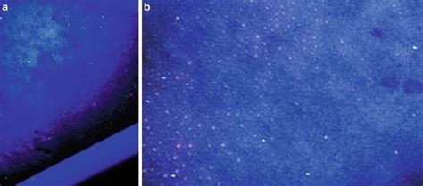 Progressive Macular Hypomelanosis Springerlink