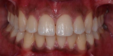 Class Ii Div I Acorn For Dentists