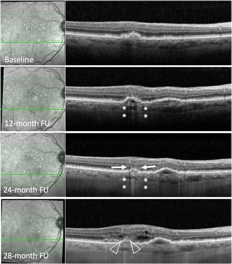 Nascent Geographic Atrophy As A Predictor Of Type 3 Macular Neovascularization Development