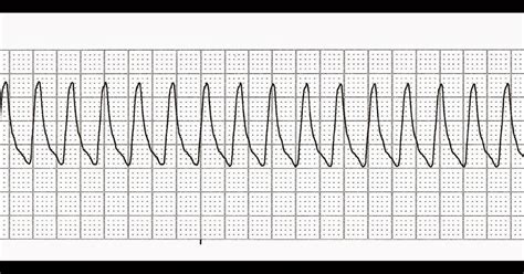 Float Nurse ACLS Questions
