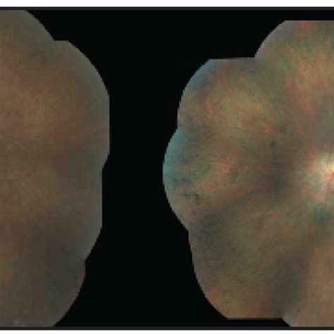 Fundus Image Showing Diffuse Atrophic Retinal Pigment Epithelium Rpe