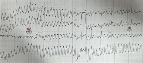 ECG Basics Fundamentals How Common Is Artifact ECG Weekly