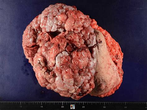 Medical Must See Giant Fungating Tumour Beggars Be Leaf Ausdoc