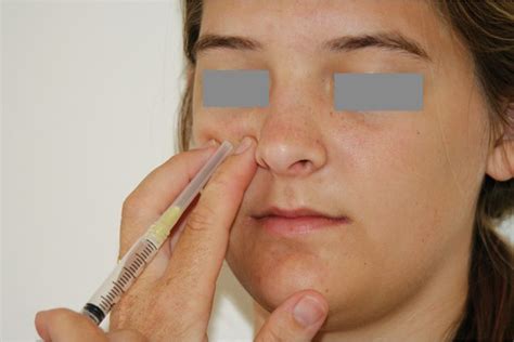 Periorbital Nerve Blocks Supraorbital Supratrochlear And