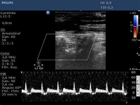 Bunny Rabbit Sign Ultrasound Ultrasound Guided Block Of The Sciatic