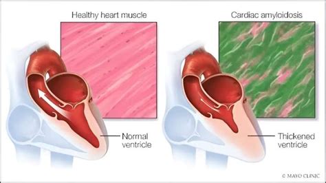 Cardiac Amyloidosis Why Early Diagnosis And Targeted Treatment Matter