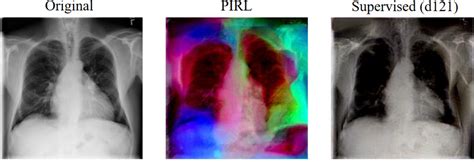Deep Image Prior Reconstructions For An Image From The Chexpert Dataset