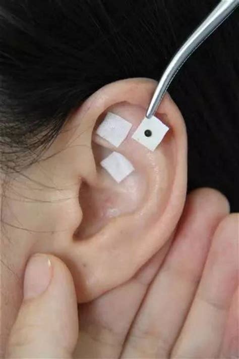 失眠不妨试试中医耳穴压豆疗法 搜狐