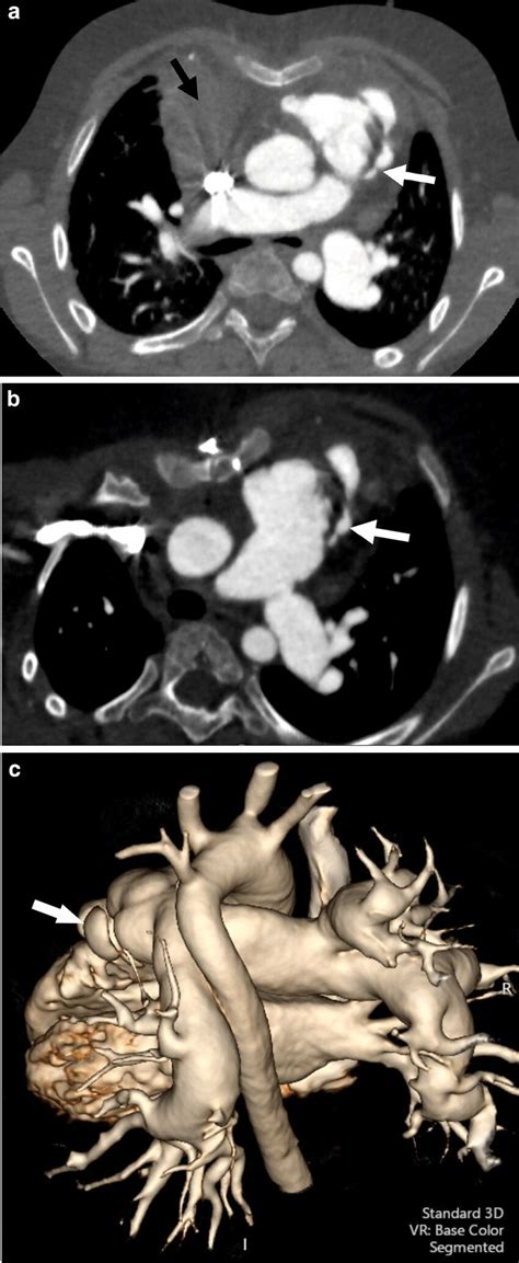 7 Year Old Girl With Tetralogy Of Fallot Status Post Complete Download Scientific Diagram