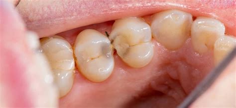 Cavities Between Teeth