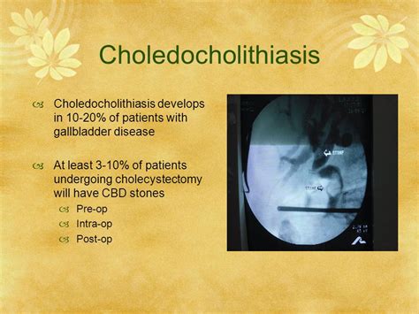 Cholangitis Management Of Choledocholithiasis Ppt Video Online Download