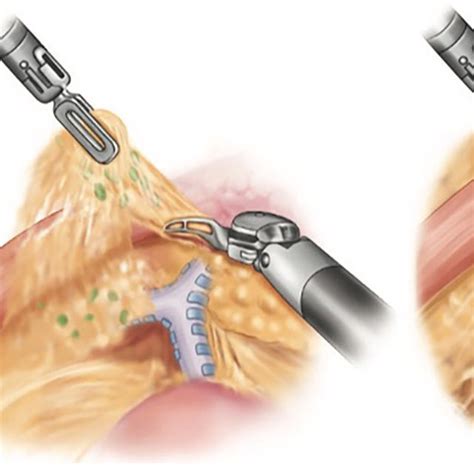 Subcarinal Lymph Node Packet Is Removed En Bloc Extreme Caution Is Download Scientific Diagram