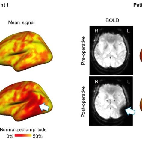 Implanted Electrode Interference Severely Reduces Bold Signal Download Scientific Diagram