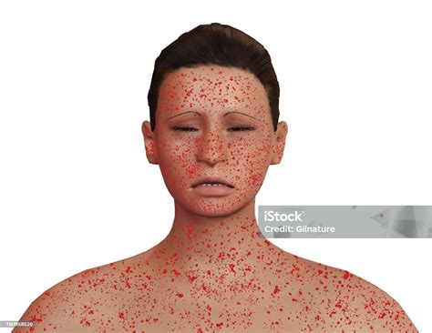 홍역 질환을 가진 젊은 여성 여러 붉은 반점과 발열이있는 몸을 가진 피부 흰색 배경에 고립 3d 렌더링 독성 피부염에 대한 스톡 사진 및 기타 이미지 Istock