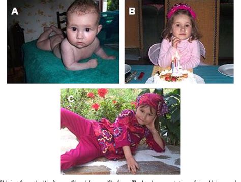 Figure 1 From Are All Cases Of Low Grade Mosaic Trisomy 13 In Amniotic