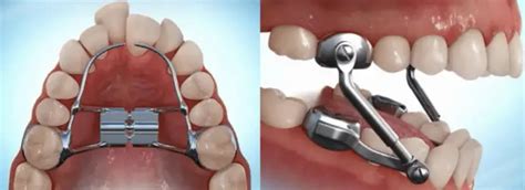 What Is A Herbst Appliance Orthodontix