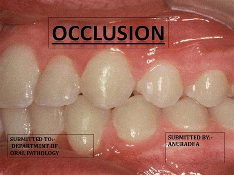 Occlusion PPTX