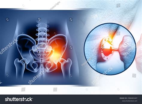 Hip Implant Artificial Joint 3d Illustration Stock Illustration 2366401447 Shutterstock
