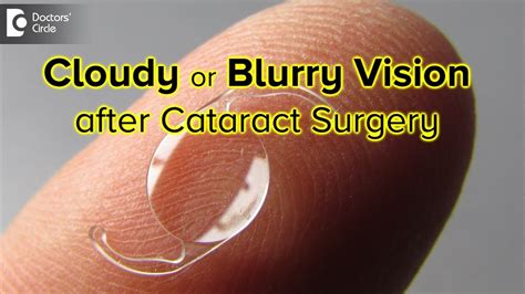 Blurred Vision After Cataract Surgery How To Manage Dry Eye After