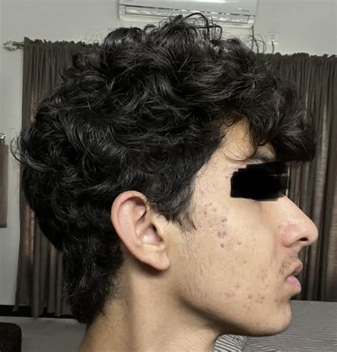 Can I Fix This Assymetry Rorthotropics