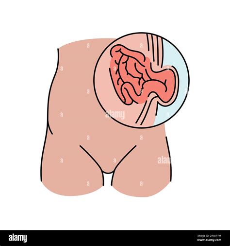 umbilical hernia line icon vector isolated element editable stroke