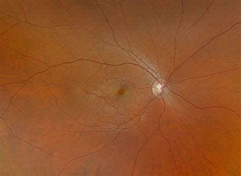 Poppers Popping Macula A 33 Year Old Man Was Referred To Our Departement For Evaluation Of